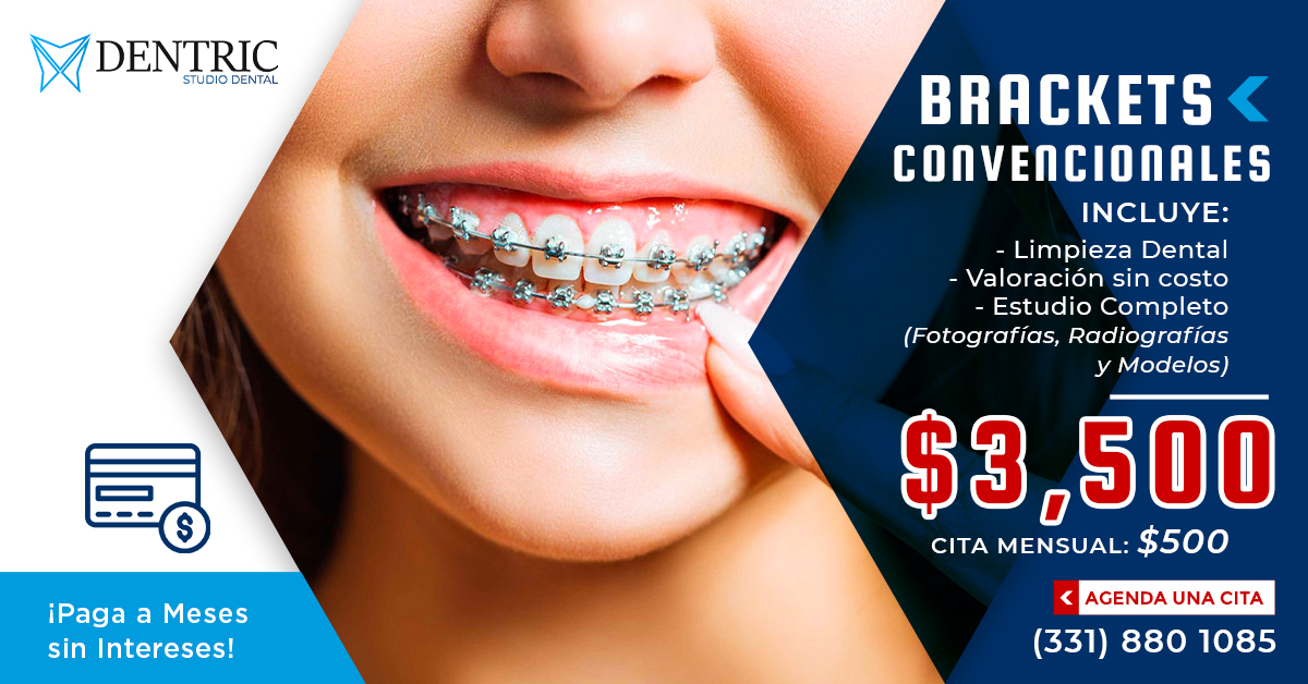 Brackets – Dentric